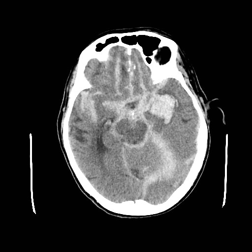 ESCALA DE FISHER | consultadeneurologia
