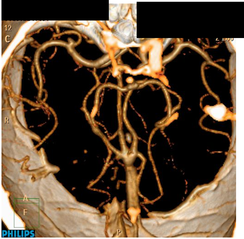Tratamiento endovascular del ictus agudo (II) | consultadeneurologia
