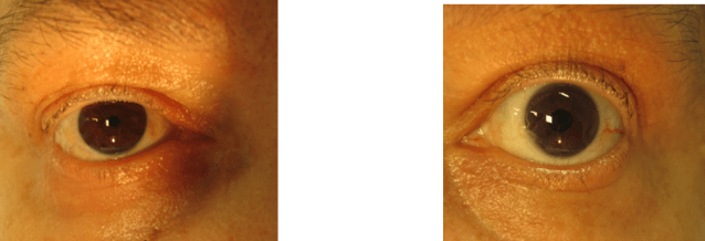 Síndrome de Horner | consultadeneurologia