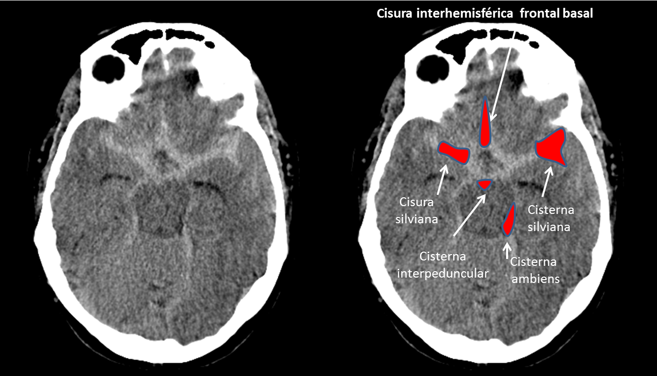 Hemorragia subaracnoidea: escala de Fisher | consultadeneurologia